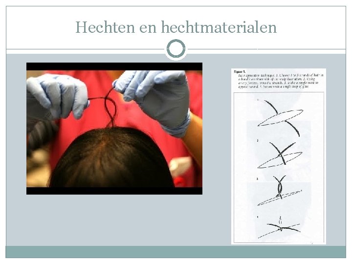 Anesthesie en hechten Lokale anesthesie Lokaal plaatselijke verdoving