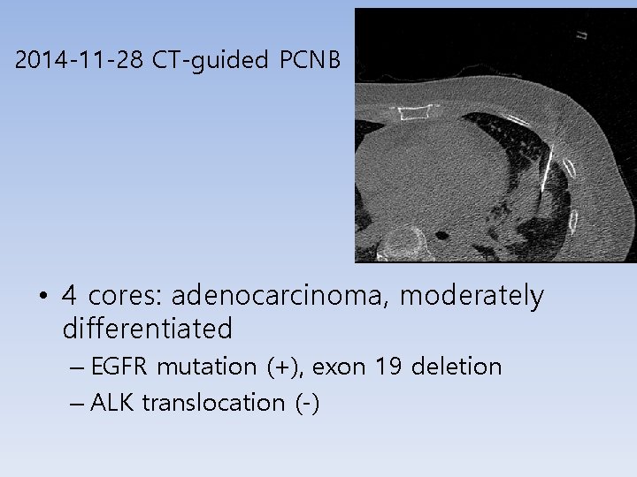 CTguided percutaneous coreneedle biopsy Semiautomatic coaxial system TSK