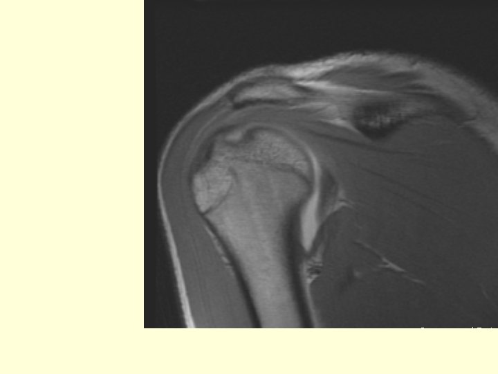 Shoulder Anatomy This is an axial T 1