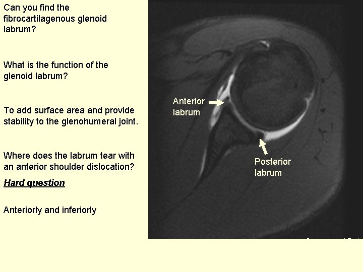 Shoulder Anatomy This is an axial T 1