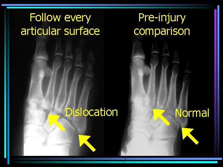 HOW TO APPROACH THE RADIOGRAPHIC DIAGNOSIS OF FRACTURES