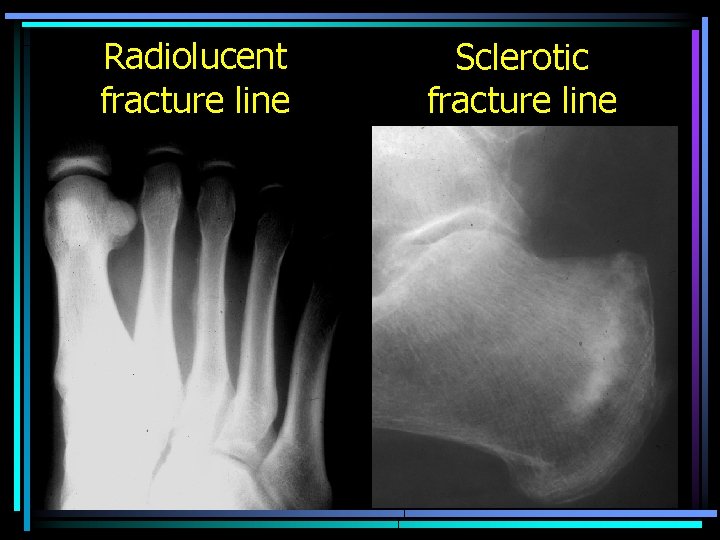 HOW TO APPROACH THE RADIOGRAPHIC DIAGNOSIS OF FRACTURES