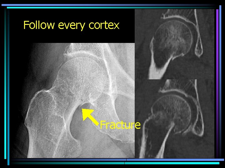 HOW TO APPROACH THE RADIOGRAPHIC DIAGNOSIS OF FRACTURES