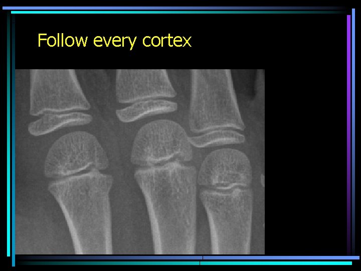 HOW TO APPROACH THE RADIOGRAPHIC DIAGNOSIS OF FRACTURES