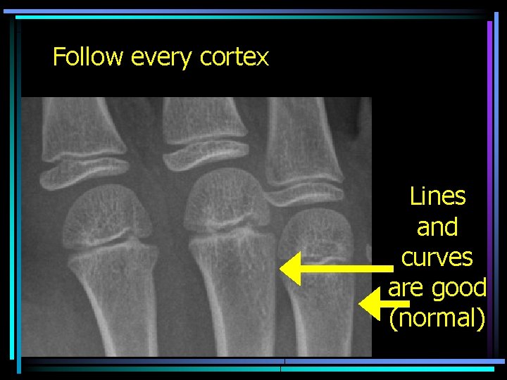 HOW TO APPROACH THE RADIOGRAPHIC DIAGNOSIS OF FRACTURES