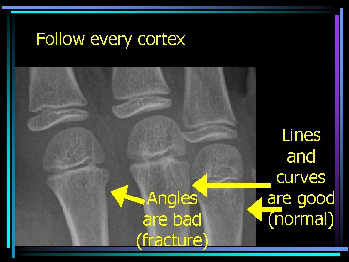 HOW TO APPROACH THE RADIOGRAPHIC DIAGNOSIS OF FRACTURES