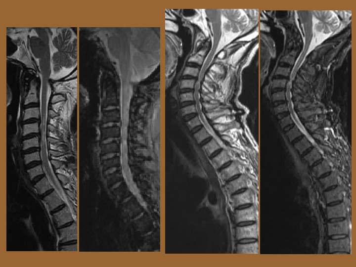 IMAGERIE DE LA MYELOPATHIE CERVICARTHROSIQUE SOUEI MHIRI MASSARRA