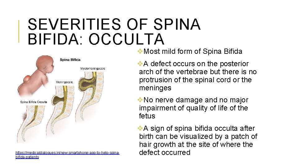 C 35 SPINA BIFIDA IN UTERO OBJECTIVES Describe