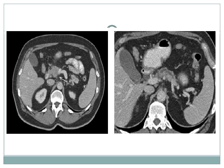 Biliary Tract Intra hepatic ducts Exta hepatic ducts