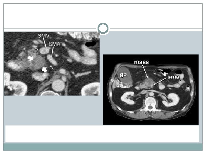 Biliary Tract Intra hepatic ducts Exta hepatic ducts