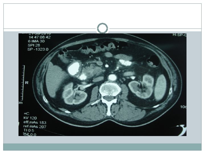 Biliary Tract Intra hepatic ducts Exta hepatic ducts