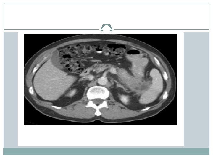 Biliary Tract Intra hepatic ducts Exta hepatic ducts