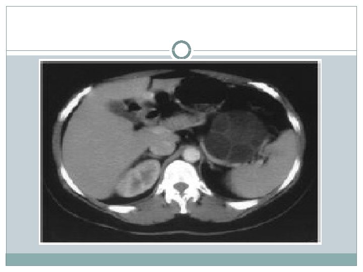 Biliary Tract Intra hepatic ducts Exta hepatic ducts