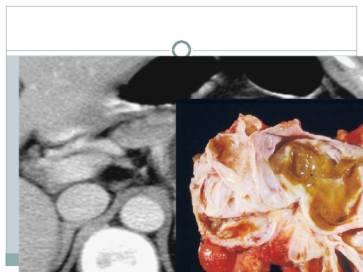 Biliary Tract Intra hepatic ducts Exta hepatic ducts