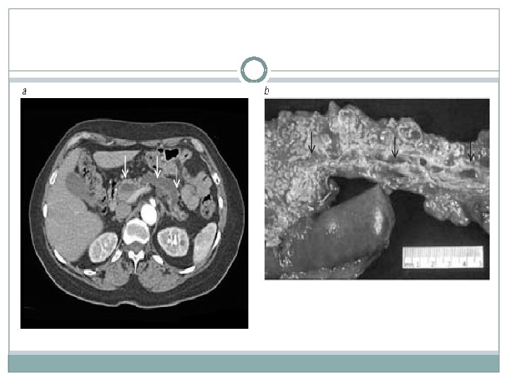 Biliary Tract Intra hepatic ducts Exta hepatic ducts