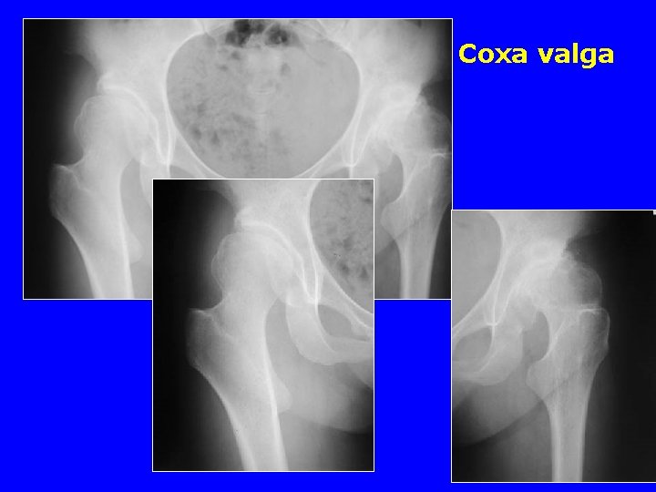 Cadera Normal Coxa Valga y displasia del acetbulo