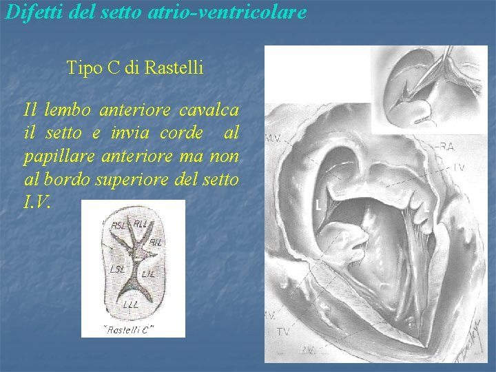 La circolazione extracorporea CEC Prof Roberto Gaeta Chirurgia