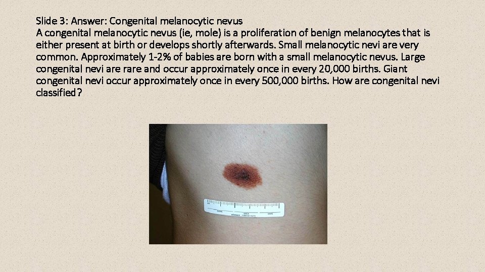 Mole or Melanoma Test yourself with these suspicious