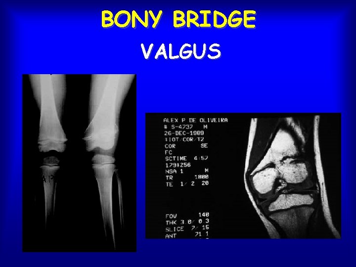 DISTAL FRACTURES OF THE FEMUR NEI BOTTER MONTENEGRO