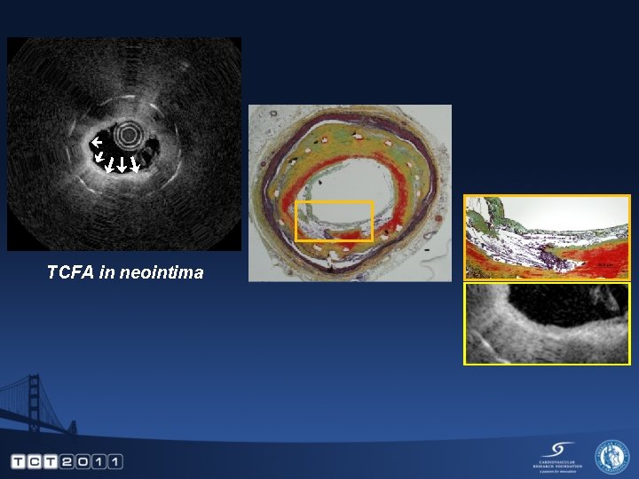 OCT Use in Stent Thrombosis and Neoatherosclerosis Gary