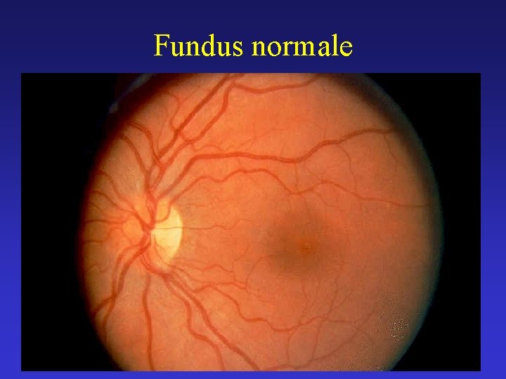 Fundus normale Microaneurismi Microemorragie Essudati cotonosi Essudati ...