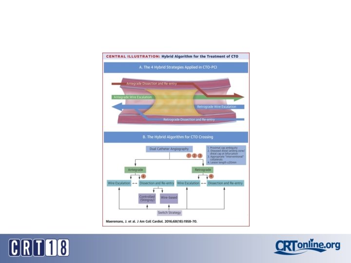 BelowtheKnee CTOs Crossing from Above with Wires and