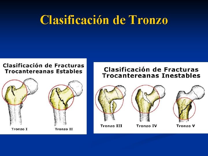 Fracturas de Fmur Dr Alfredo Donoso Barros Jefe