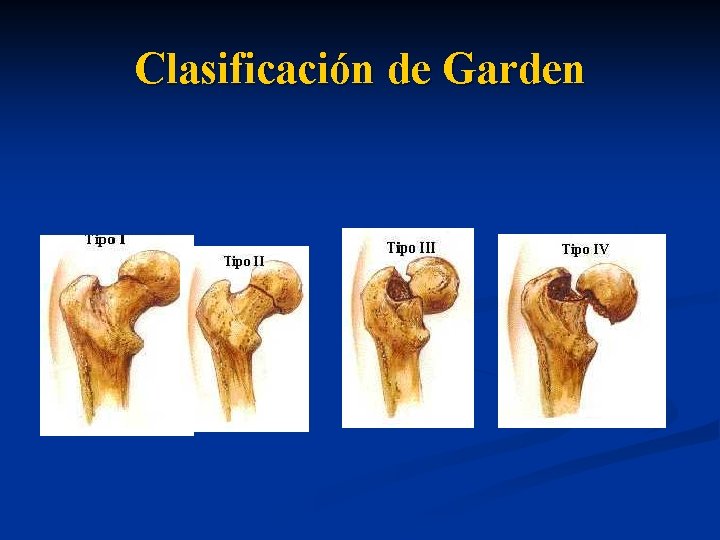 Fracturas de Fmur Dr Alfredo Donoso Barros Jefe