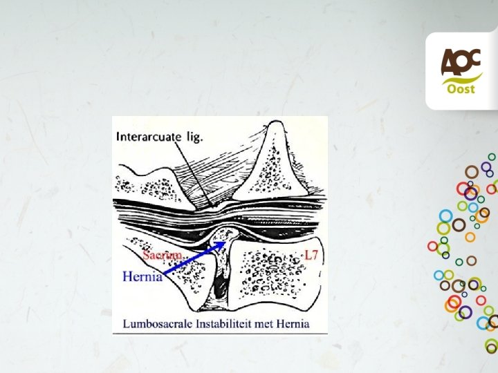 Rug aandoeningen Inhoud Anatomie wervelkolom Wobbler syndroom Hernia