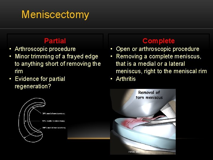 MENISCAL REPAIR Anatomy and Physiology of the Meniscus