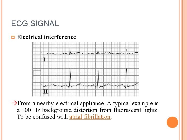 ECG SIGNAL ACQUISITION HARDWARE DESIGN University of Alabama