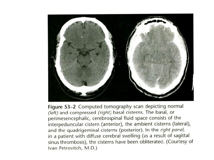 maattarimed mui ac ir Pathophysiology Of Intracranial Hypertension