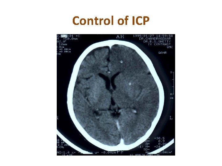 maattarimed mui ac ir Pathophysiology Of Intracranial Hypertension