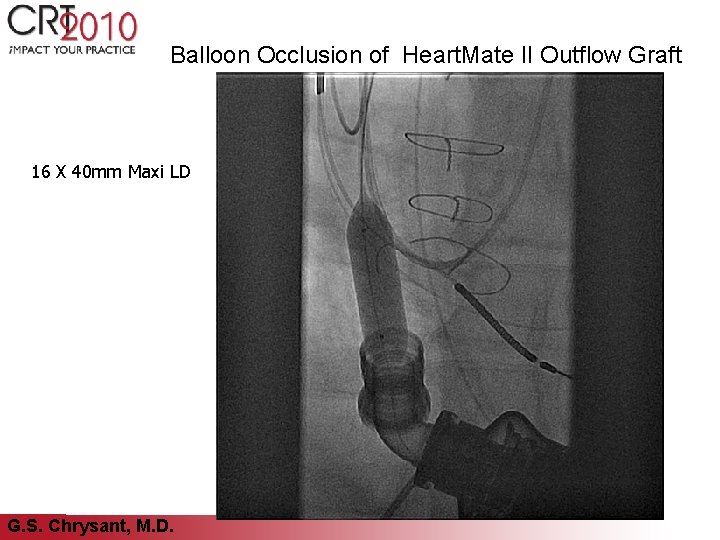 Percutaneous Management of Acute LVAD Stoppage George S