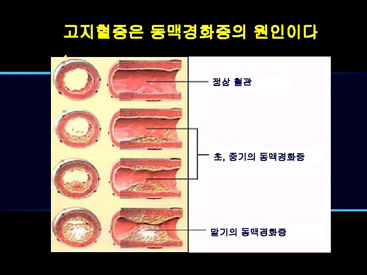 Frederickson Classification of Hyperlipoproteinemia Phenotype I IIa IIb