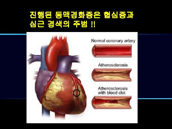 Frederickson Classification of Hyperlipoproteinemia Phenotype I IIa IIb