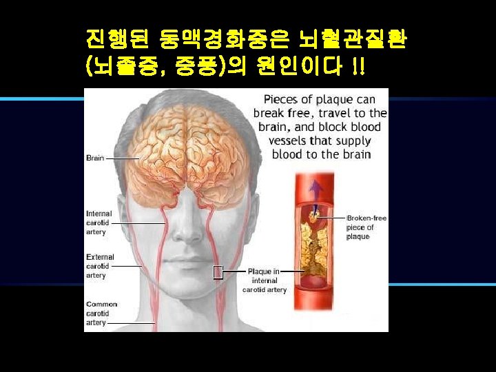 Frederickson Classification of Hyperlipoproteinemia Phenotype I IIa IIb