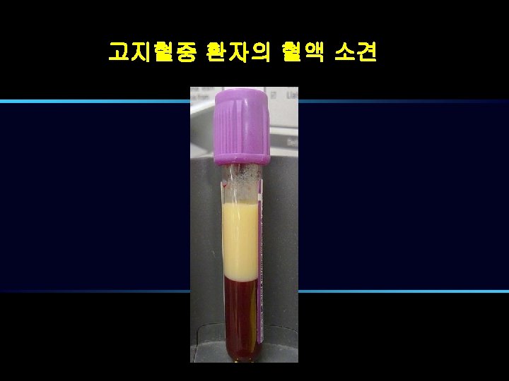 Frederickson Classification of Hyperlipoproteinemia Phenotype I IIa IIb