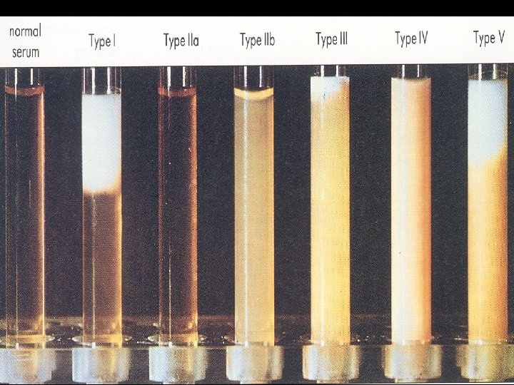 Frederickson Classification of Hyperlipoproteinemia Phenotype I IIa IIb