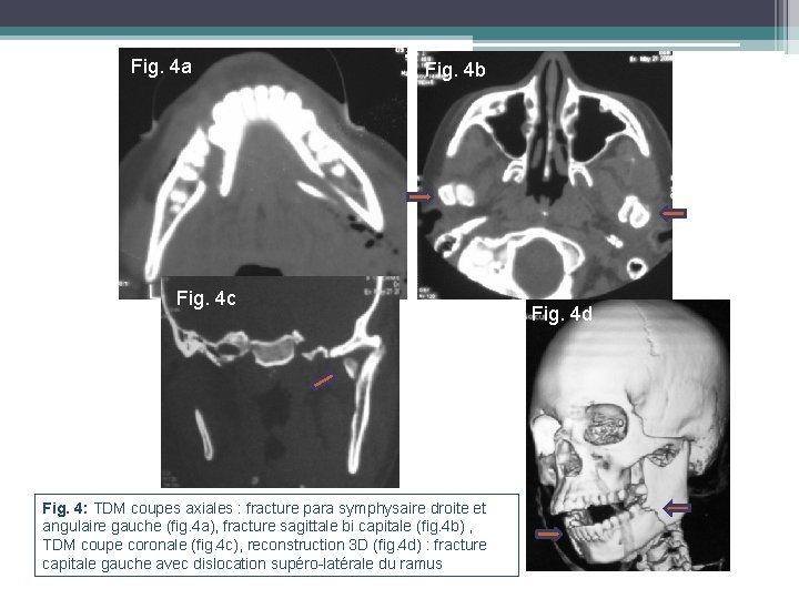 FRACTURES INTRA ARTICULAIRES DU CONDYLE MANDIBULAIRE ASPECT EN