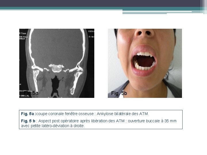 FRACTURES INTRA ARTICULAIRES DU CONDYLE MANDIBULAIRE ASPECT EN
