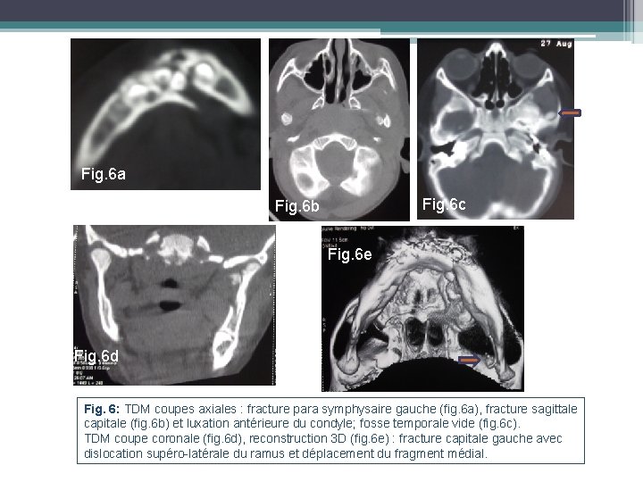 FRACTURES INTRA ARTICULAIRES DU CONDYLE MANDIBULAIRE ASPECT EN