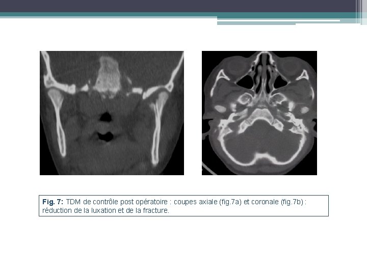 FRACTURES INTRA ARTICULAIRES DU CONDYLE MANDIBULAIRE ASPECT EN