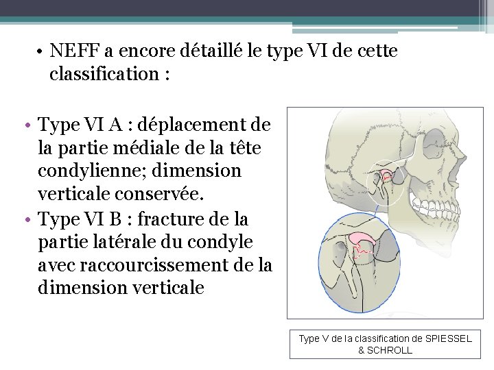 FRACTURES INTRA ARTICULAIRES DU CONDYLE MANDIBULAIRE ASPECT EN