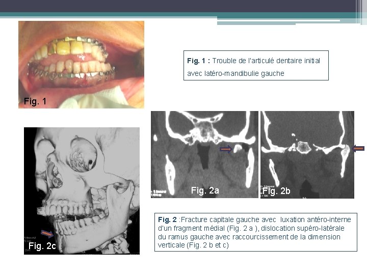 FRACTURES INTRA ARTICULAIRES DU CONDYLE MANDIBULAIRE ASPECT EN