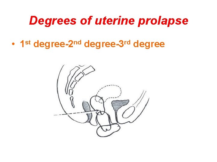 Genital prolapse DISPLACEMENTS OF THE UTERUS The uterus