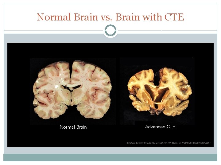 Chronic Traumatic Encephalopathy CTE in the National Football
