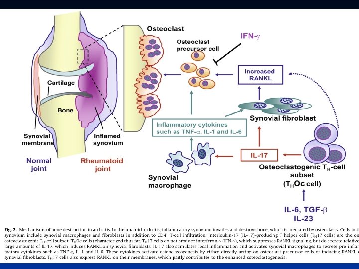 PATOGENESIS DE LA ARTRITIS REUMATOIDEA No es sabio