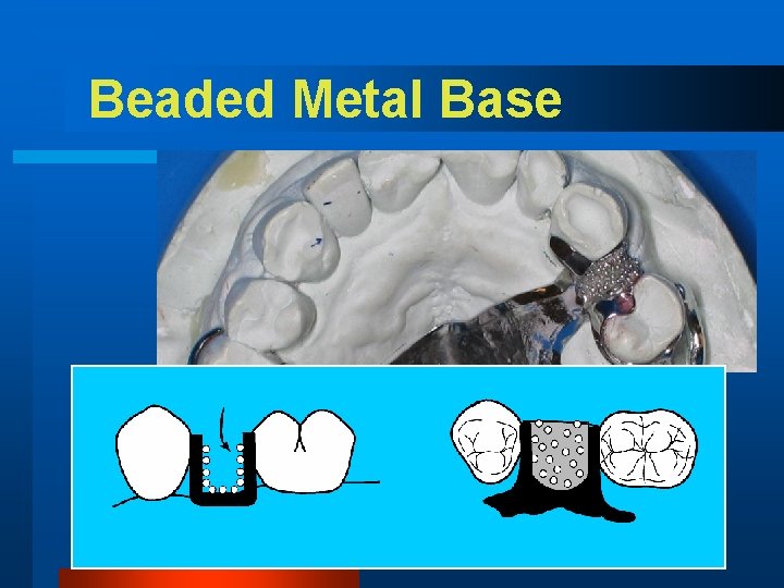 DENTURE BASES Functions Support retain denture teeth Stress