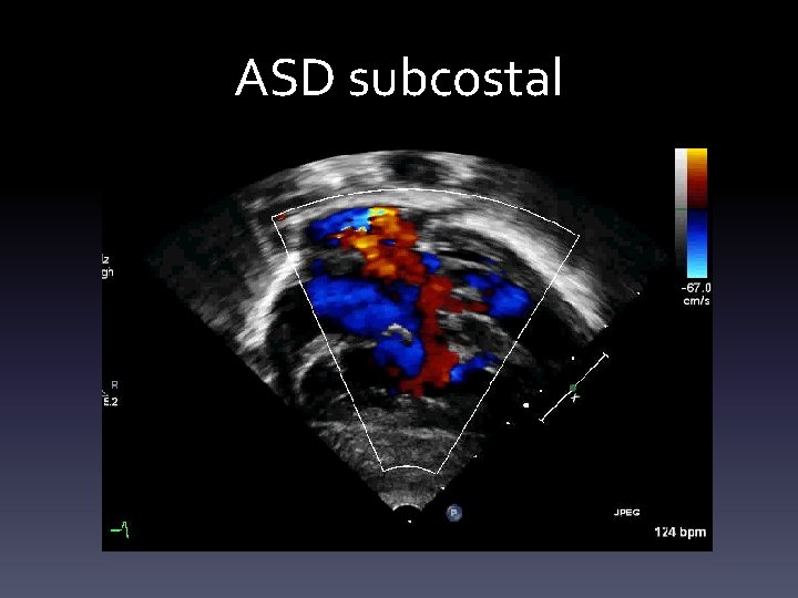 Congenital Heart Surgeon Society Atrioventricular Septal Defect prospective